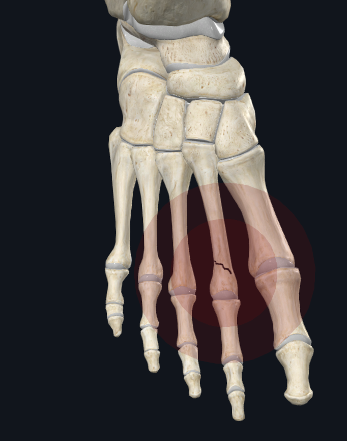 Affections courantes de l'avant-pied Origine diagnostic et traitement ...