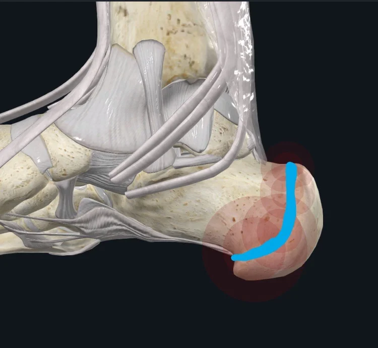 Douleurs au talon : Origine, diagnostic et traitement ...