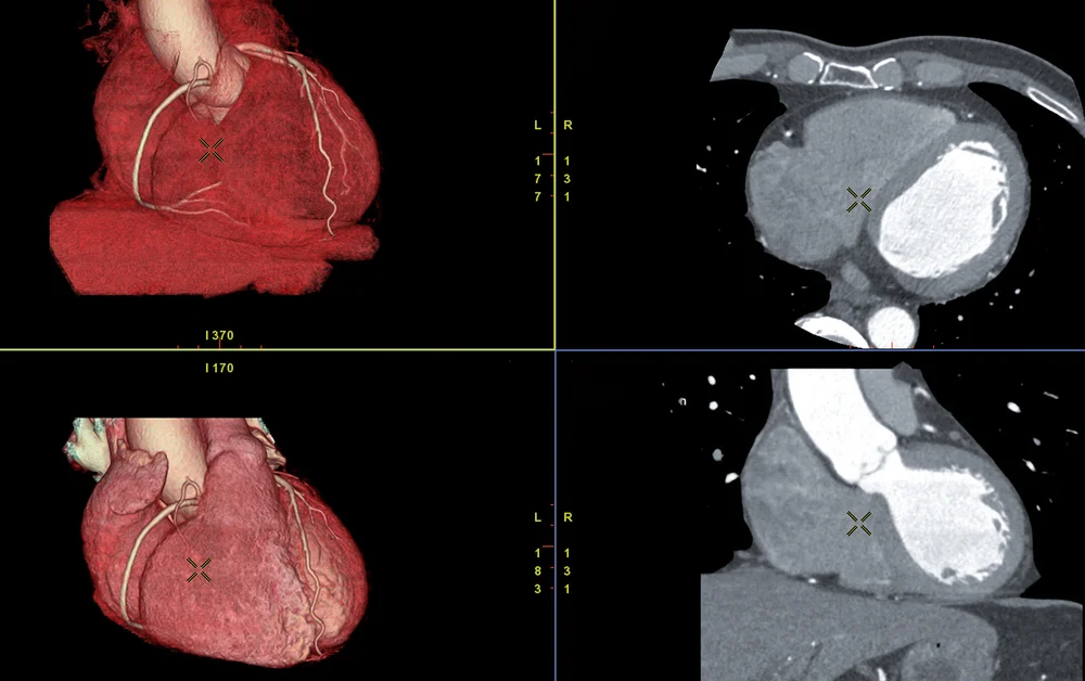 CT Coronary Angiogram — Dr Young Yu · Cardiologist · Sydney