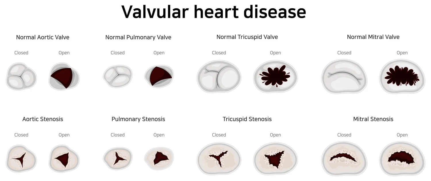 Structural Heart Disease — Dr Young Yu · Cardiologist · Sydney