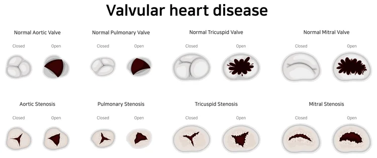 Structural Heart Disease — Dr Young Yu · Cardiologist · Sydney