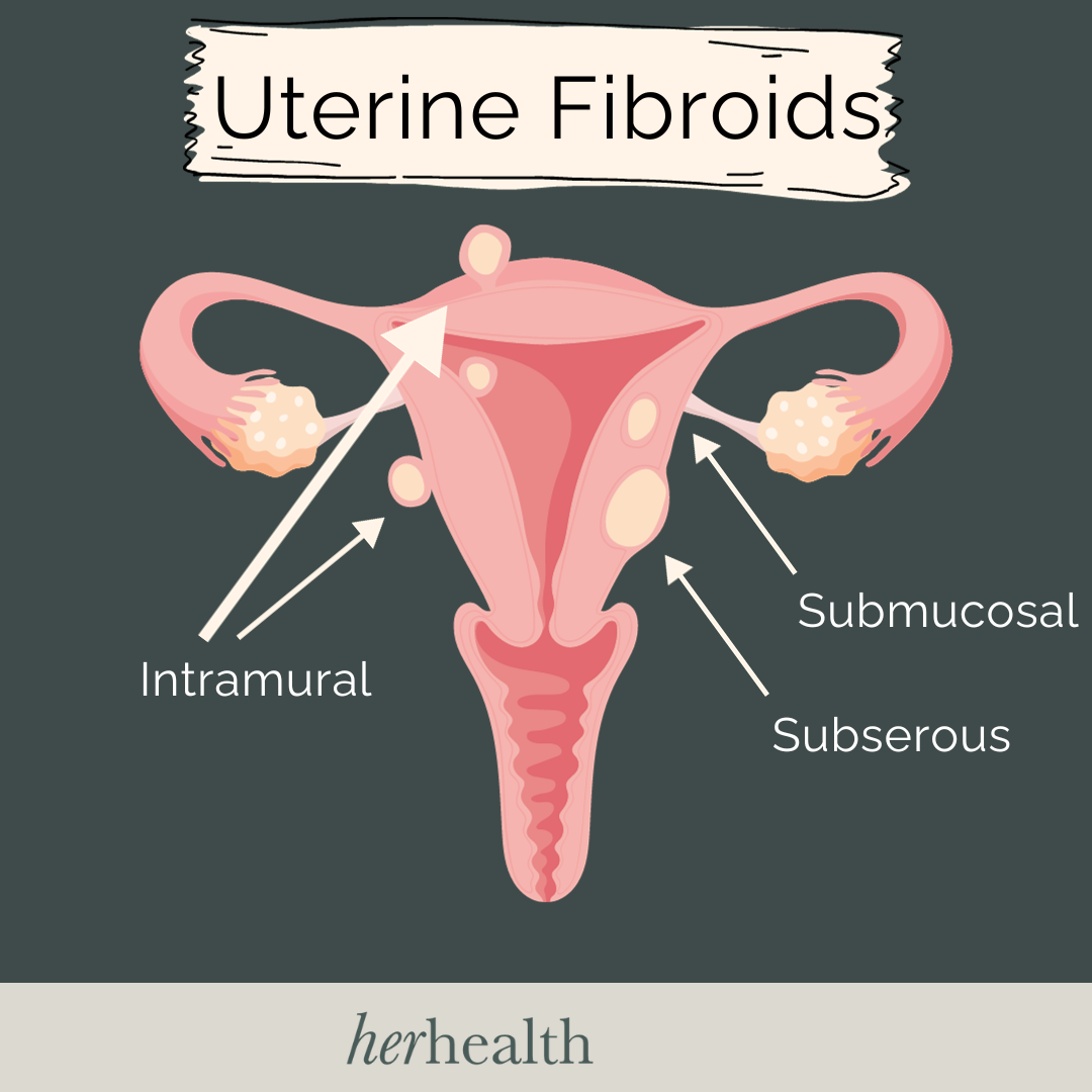 Fibroids And Pregnancy What To Know