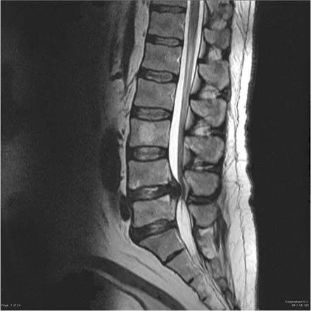 LUMBAR SPINAL STENOSIS: A REVIEW — WILLIAM J. BONNER, MD