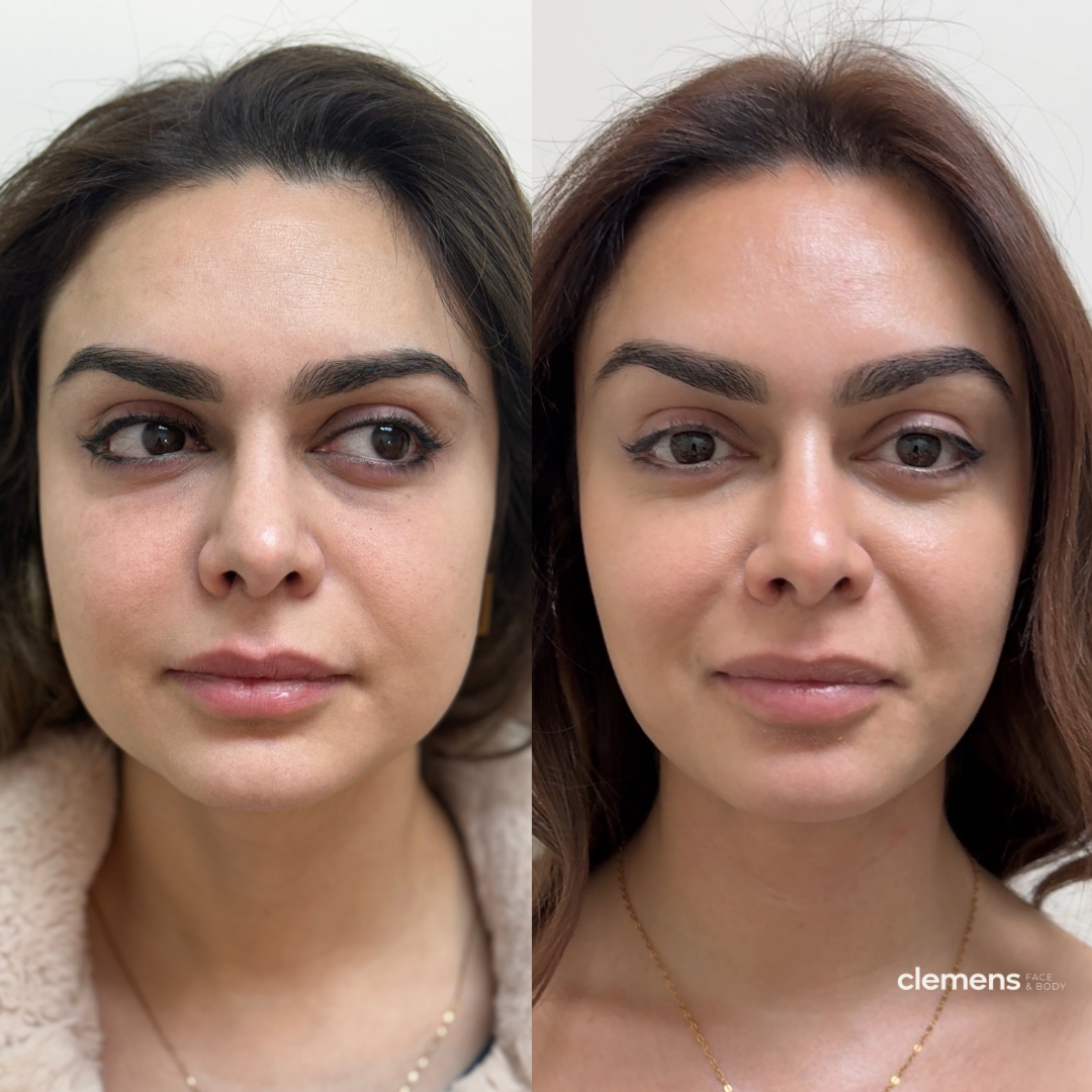 Clemens Face + Body | Boston's Top Injectable Studio