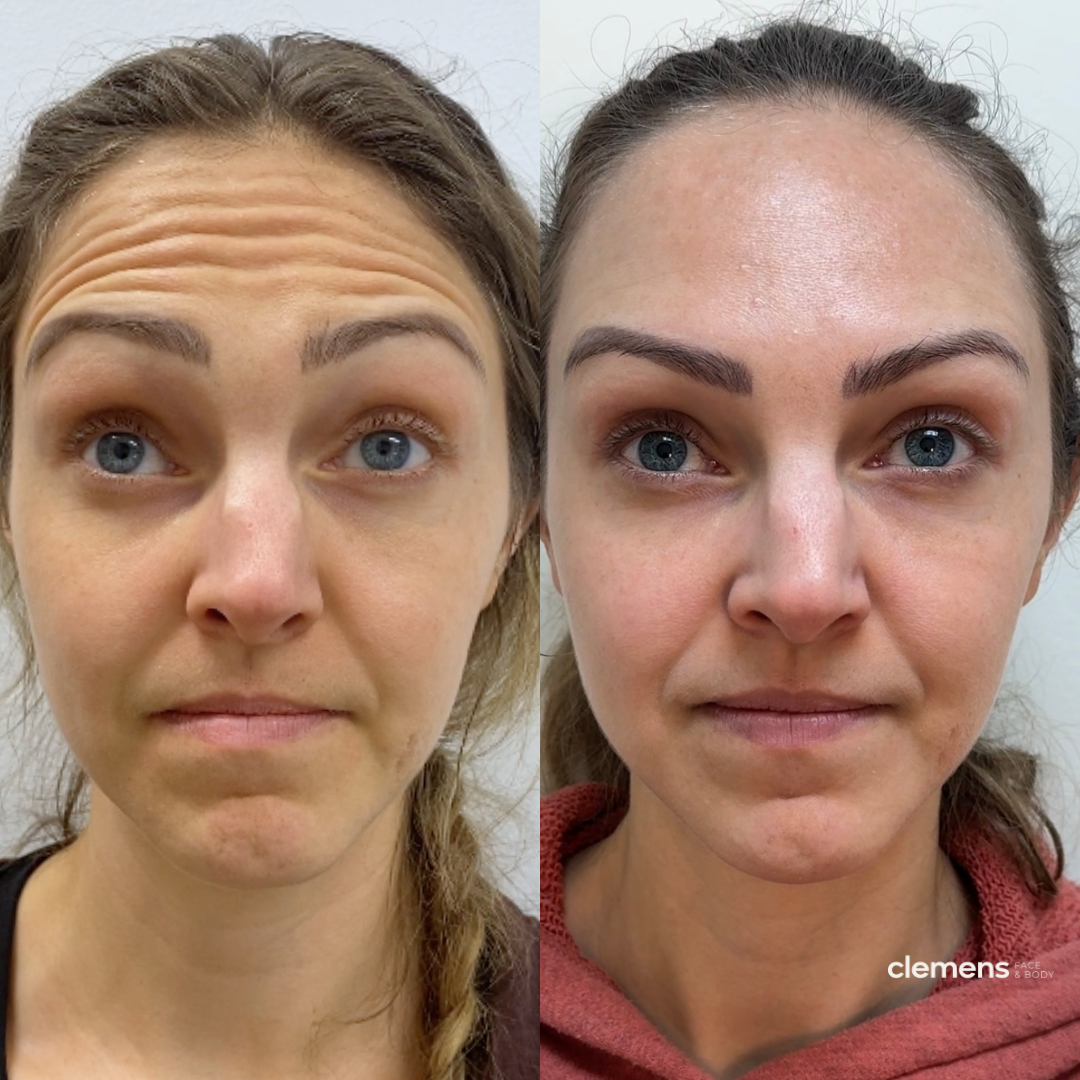 Clemens Face + Body | Boston's Top Injectable Studio