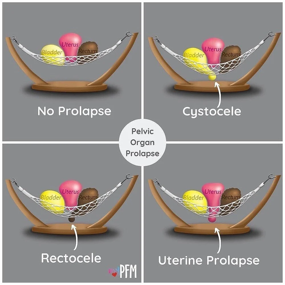 A Holistic Approach To Pelvic Organ Prolapse Pelvic Floor Physical