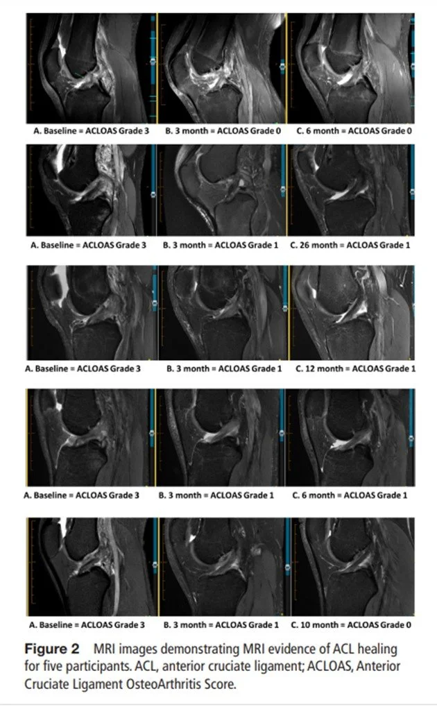 ACL Healing with the Cross Bracing Protocol on the Northern beaches ...