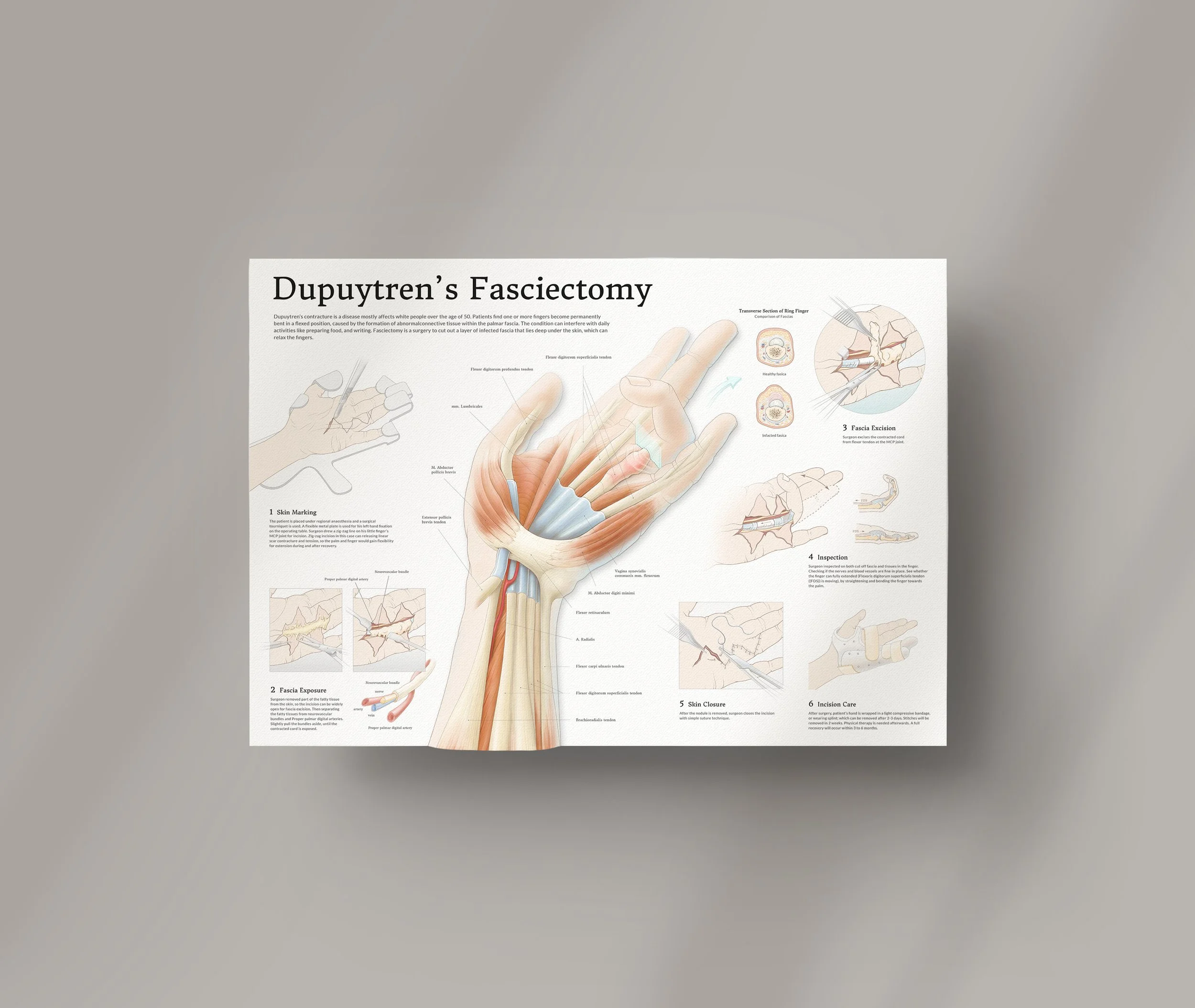 Dupuytren’s fasciectomy {illustration, infographic, scientific research ...