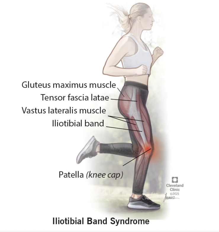 IT Band injuries/ Lateral Knee pain in Runners