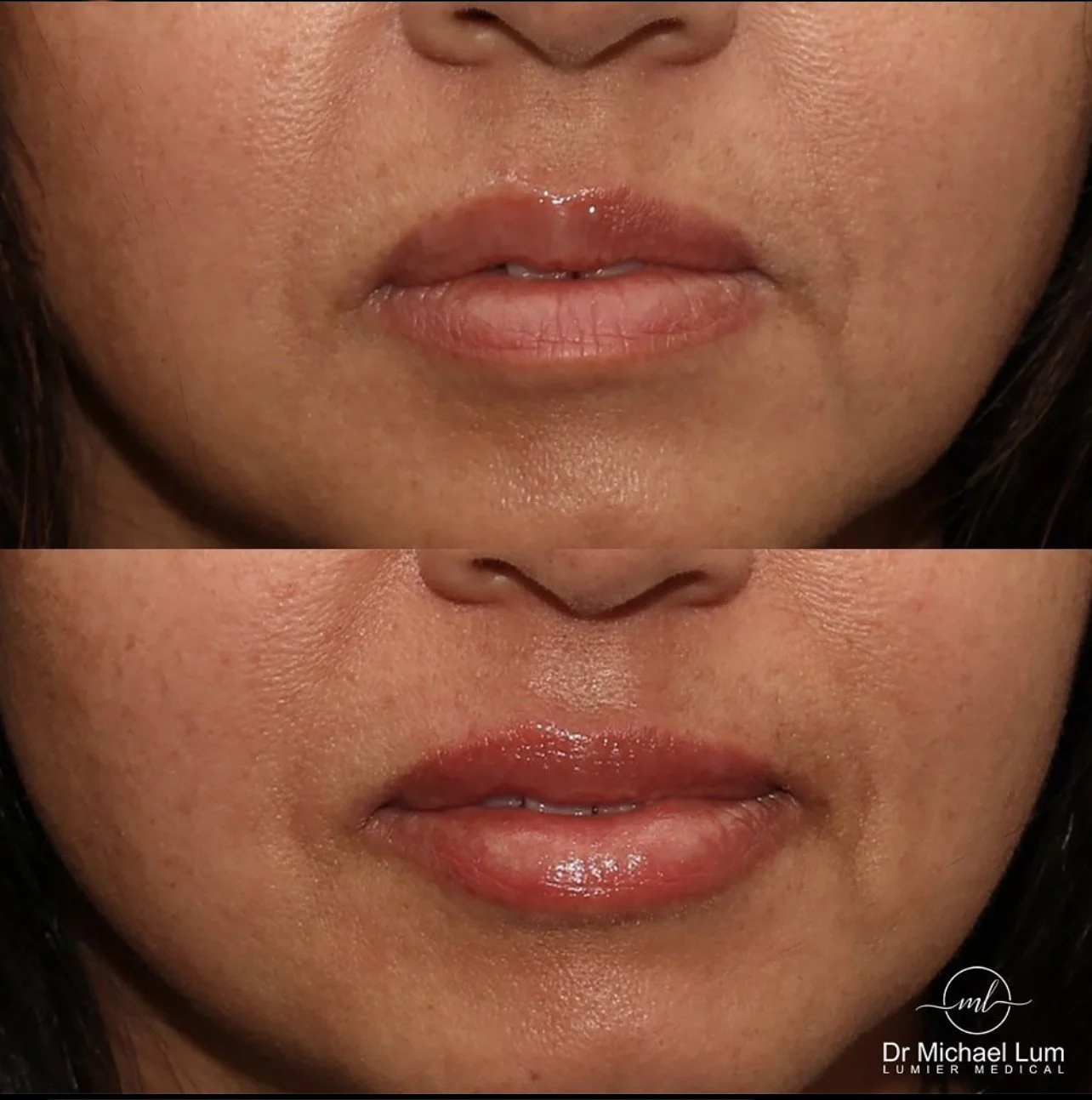 Dermal Fillers in Torrance, CA — Lumier Medical