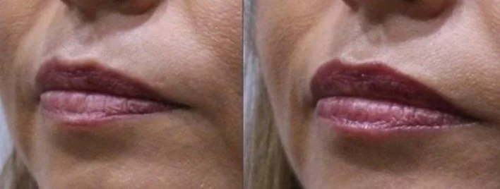 Botox® Lip Flip Treatment near me | Torrance, CA — Lumier Medical