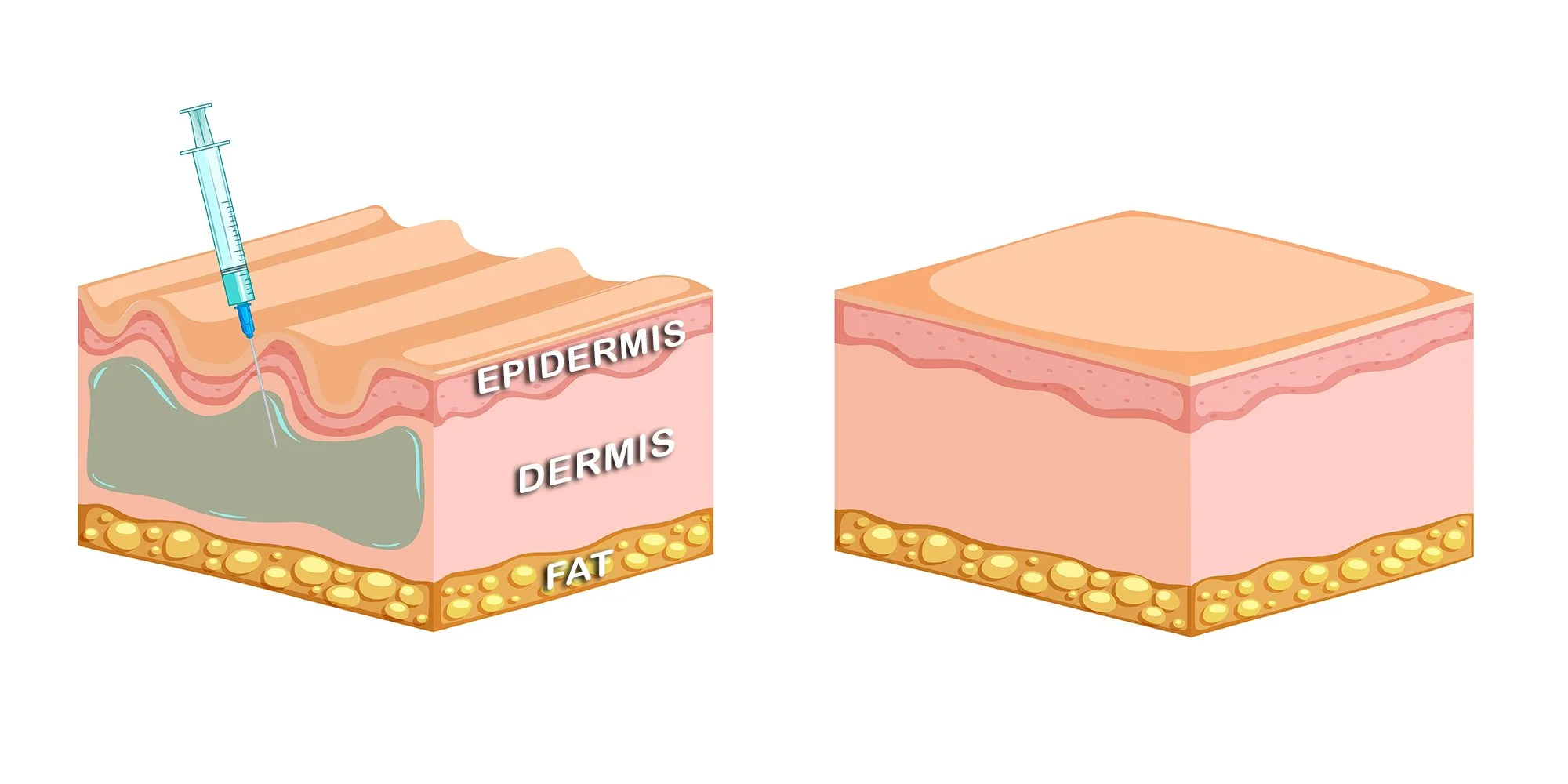 What are dermal fillers? — Lumier Medical