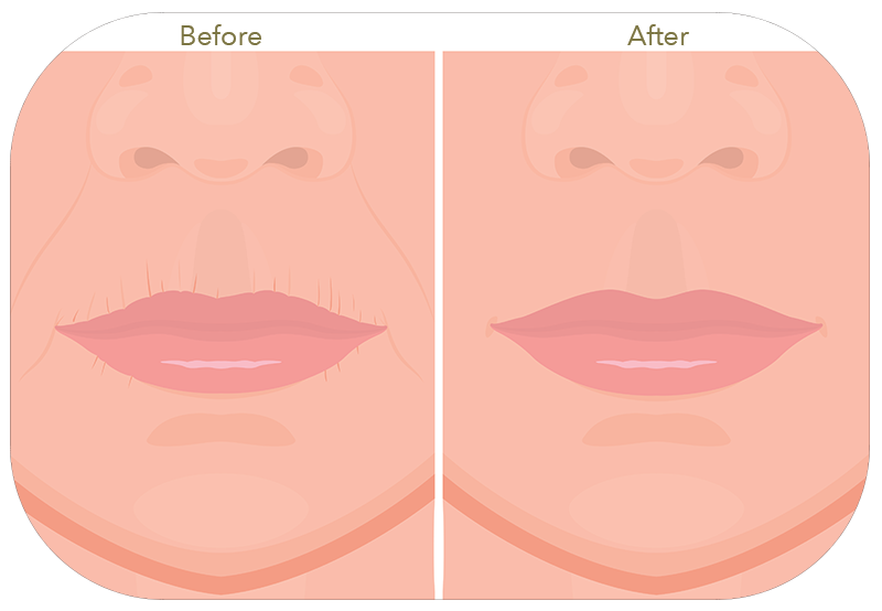 Botox® for lipstick lines | Torrance, CA — Lumier Medical