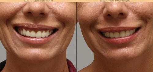 Botox® for gummy smile | Torrance, CA — Lumier Medical