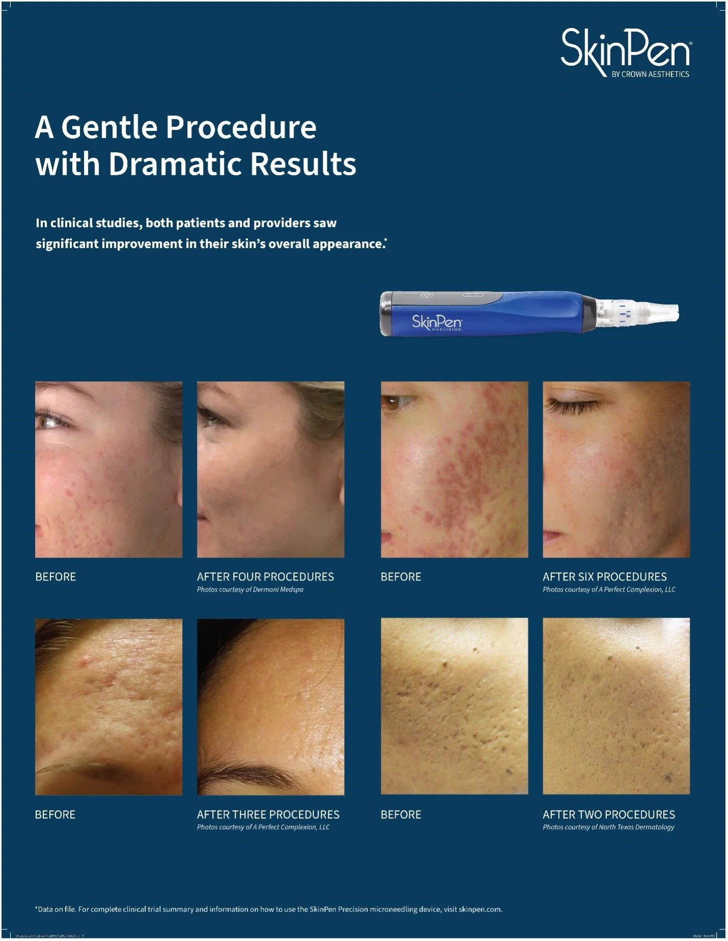 SkinPen® Precision in Torrance, CA — Lumier Medical