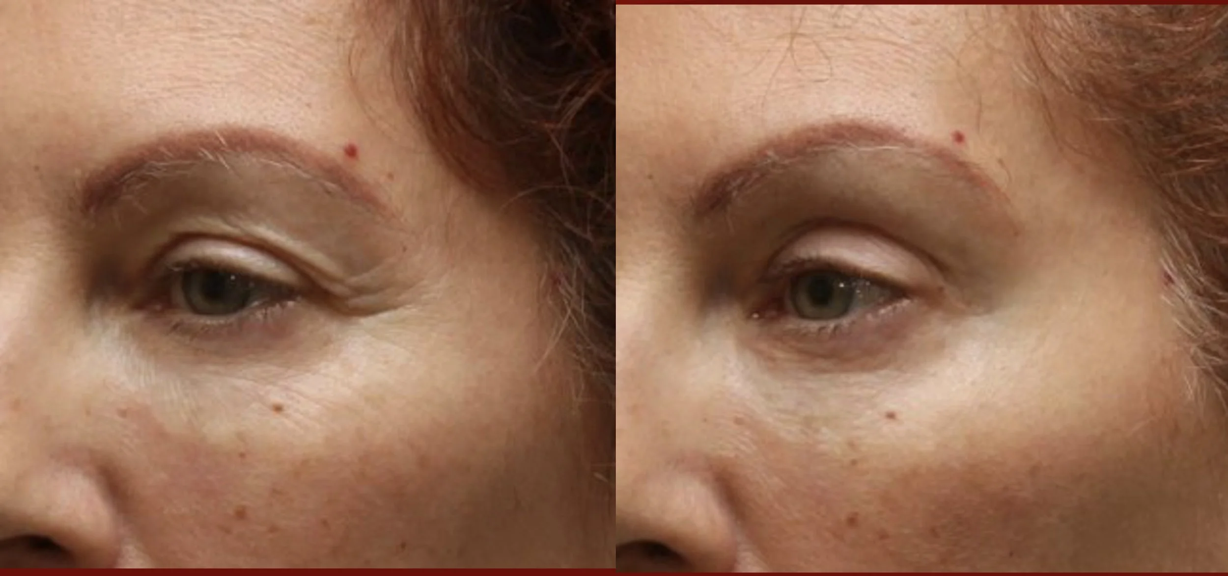 Botox® Brow Lift - Torrance, CA — Lumier Medical