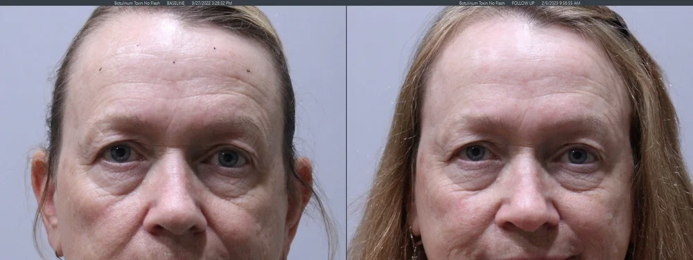 What happens when you stop Botox? — Lumier Medical