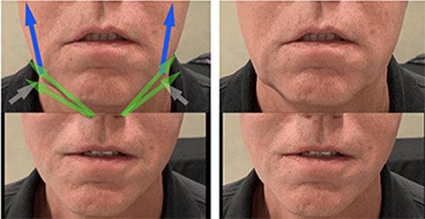 PDO THREADS — Lumier Medical