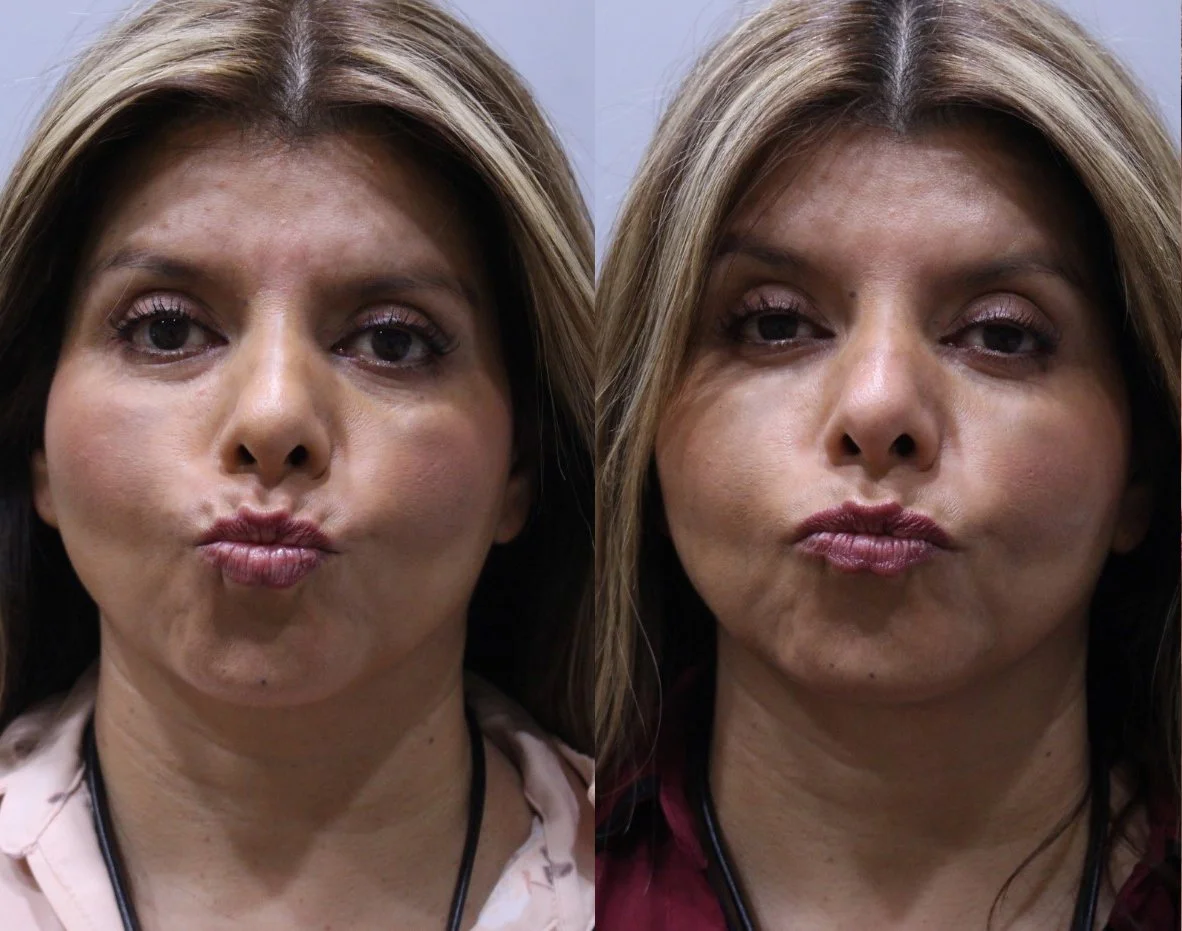 Botox® for lipstick lines | Torrance, CA — Lumier Medical