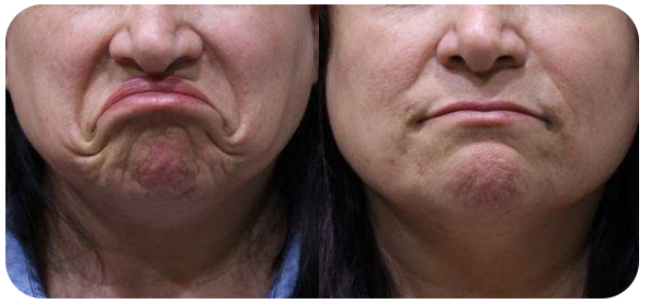 Botox® for mouth frowns | Torrance, CA — Lumier Medical