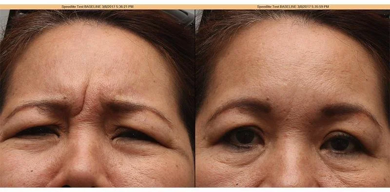 Glabella Filler — Lumier Medical