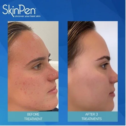SkinPen® Precision in Torrance, CA — Lumier Medical