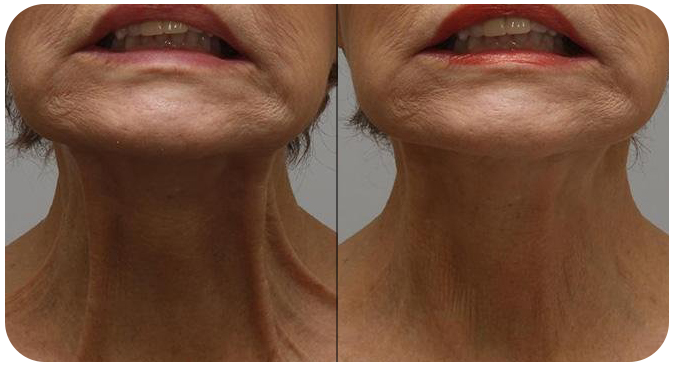 Botox® Treatment for neck bands | Torrance, CA — Lumier Medical