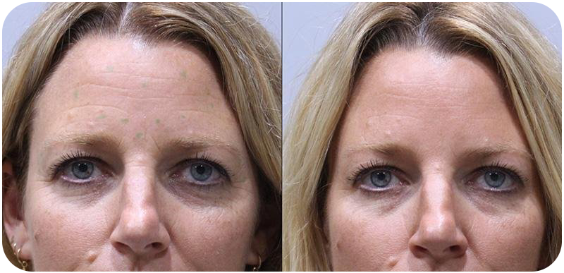 Botox® Forehead Lines Near Me in Torrance, CA — Lumier Medical