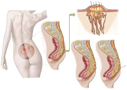 Behandeling van Sinus Pilonidalis door Dr. Van Der Fraenen - Expert ...