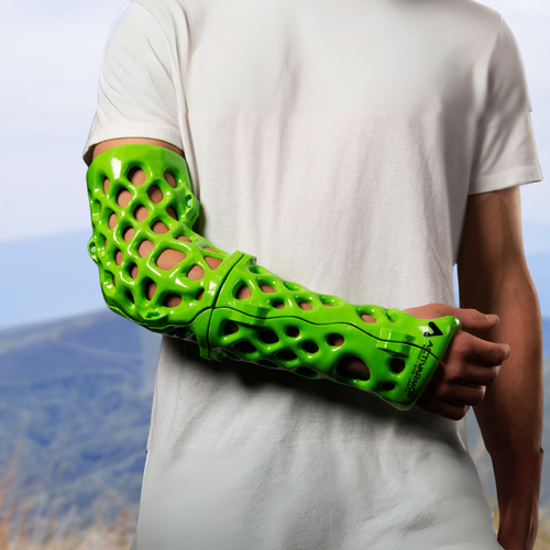 For Patients | ActivArmor | Custom 3D Printed Casts and Splints