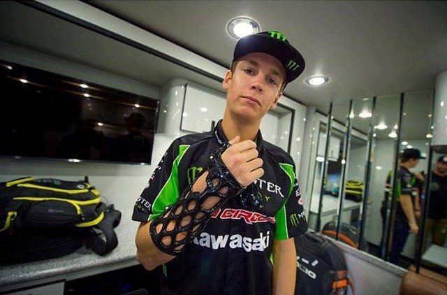 3D Printed Cast Designed For Use With Advanced Healing Technologies ...