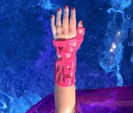 For Patients | ActivArmor | Custom 3D-Printed Casts and Splints