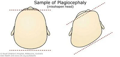 Positional Plagiocephaly — Eureka Health