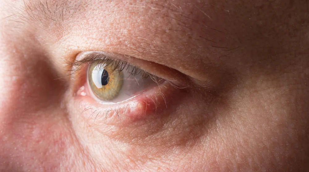 Orzuelo/Chalazión — Horta-Santini Eyecare