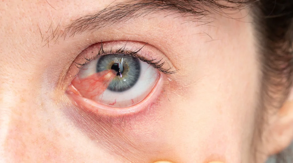 Pterygium — Horta-Santini Eyecare