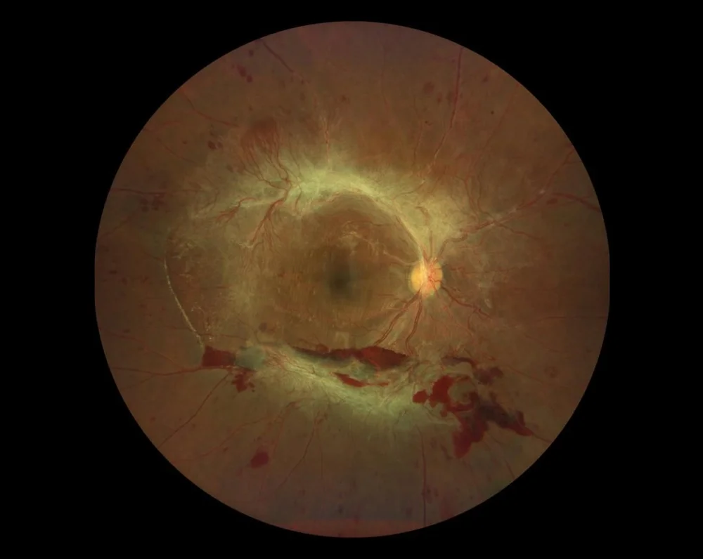Diabetic Retinopathy — Horta-Santini Eyecare