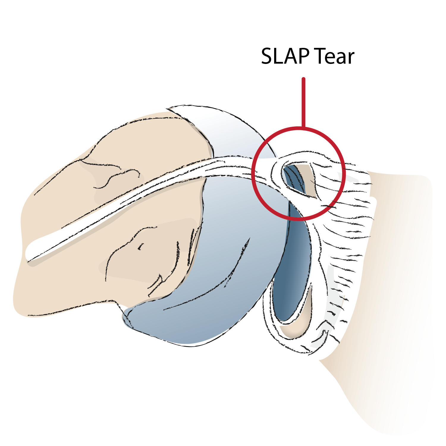 Can You Workout With a SLAP Tear? — Outlast Health and Performance ...