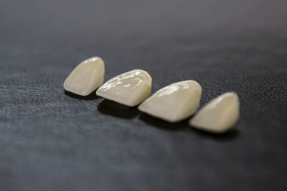 All About Front Tooth Crowns — Coral Reef Dental