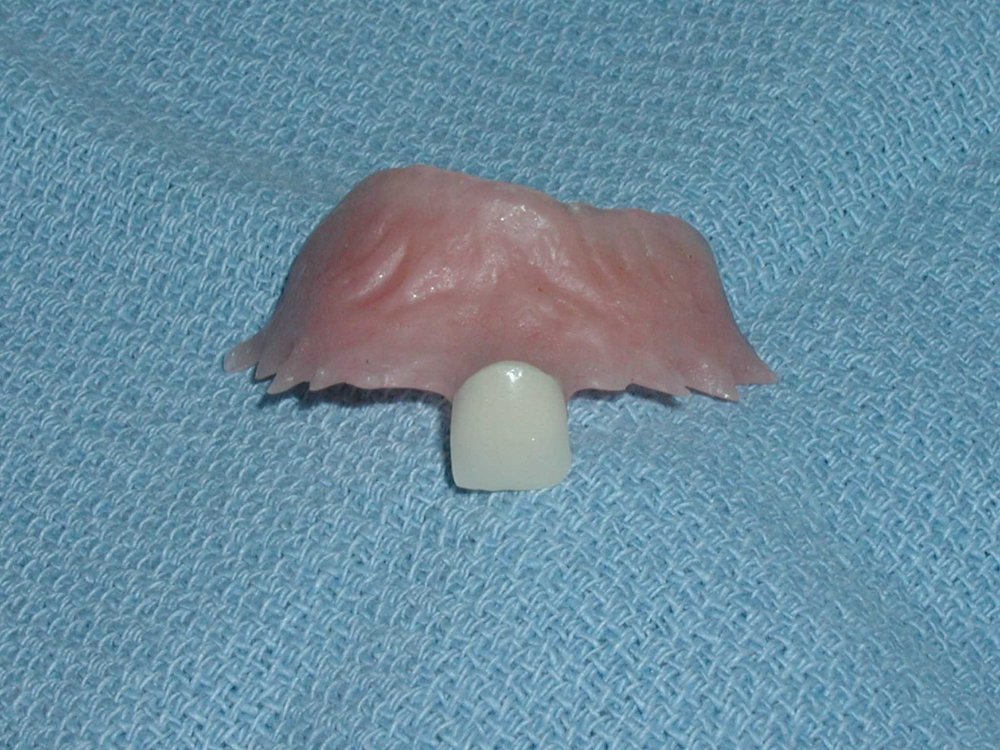 What is a Dental Flipper? Pictures of a Flipper — Coral Reef Dental