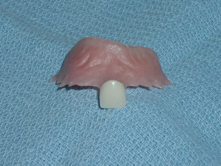 What is a Dental Flipper? Pictures of a Flipper — Coral Reef Dental