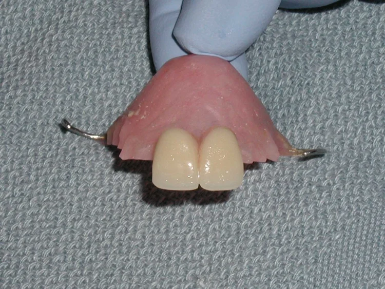 Picture of Dental Flipper for Teeth #8,9 — Coral Reef Dental