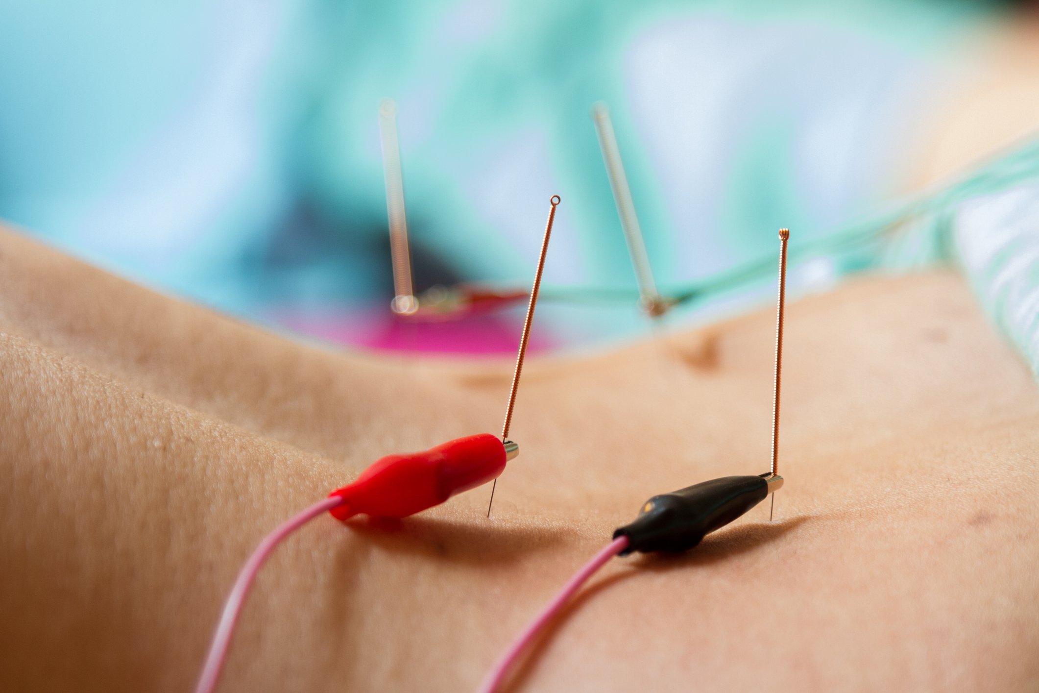 Arvada Acupuncture & Massage | Calm Spirit Acupuncture | Arvada — Calm ...