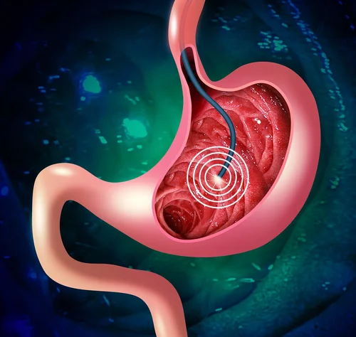 ERCP Melbourne | Pancreas, Gallbladder & Bile Duct Procedure – GSC ...