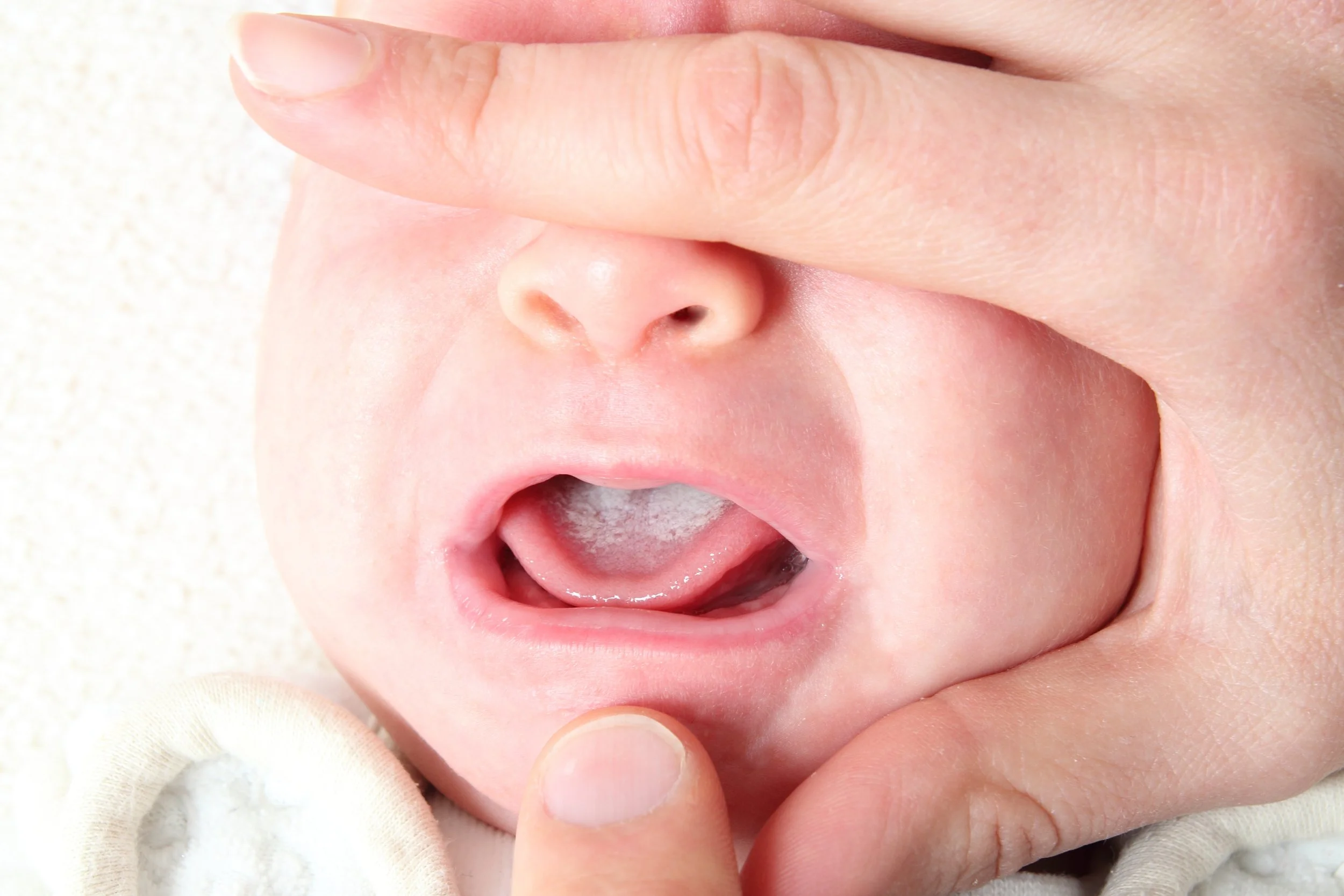 What Is Thrush and How to Prevent It — NEOwell — NEOwell