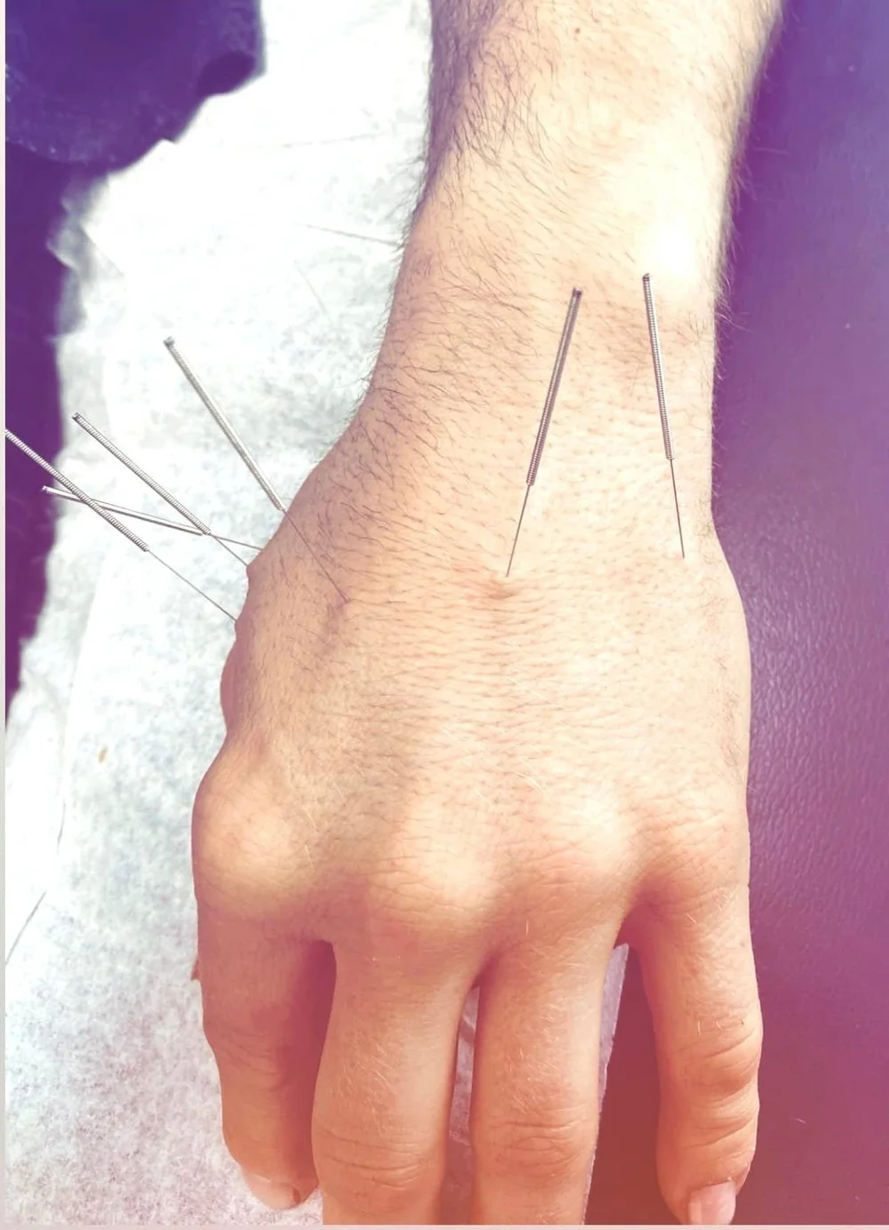 Dry Needling in Edmonton: Expert Relief for Muscle Pain & Tension ...