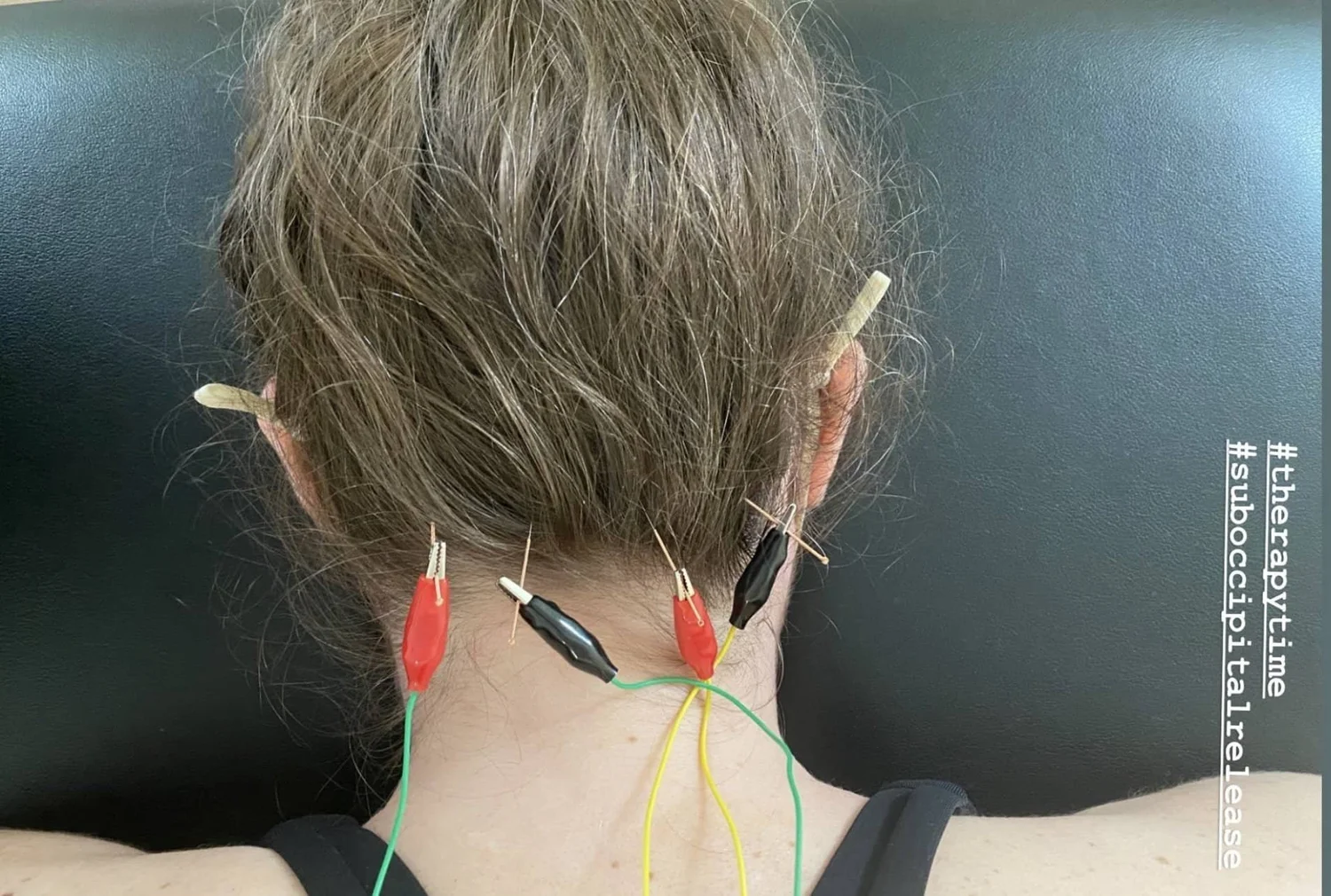 Dry Needling in Edmonton: Expert Relief for Muscle Pain & Tension ...