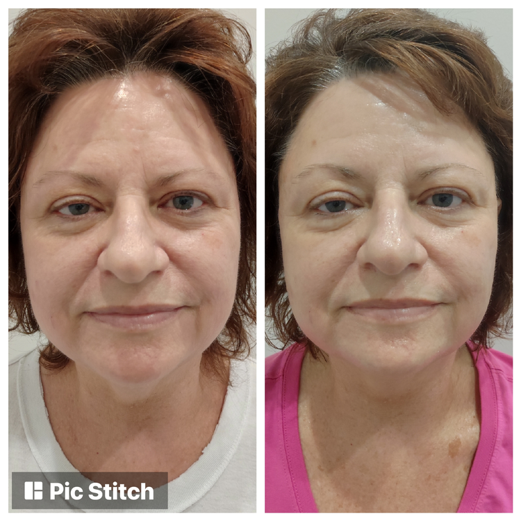 Cryo Lift Facial Houston | Skin Tightening & Glow