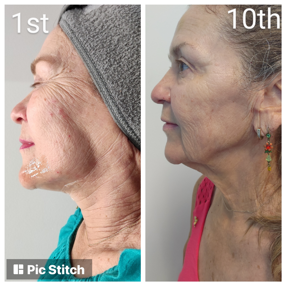 Cryo Lift Facial Houston | Skin Tightening & Glow