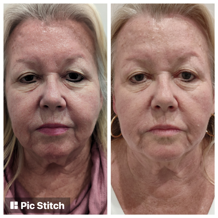 Cryo Lift Facial Houston | Skin Tightening & Glow