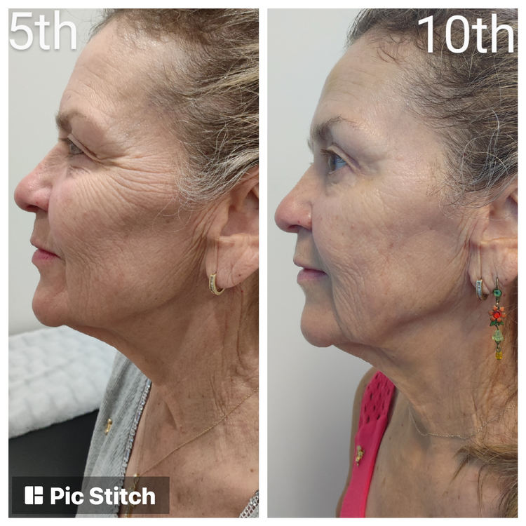 Cryo Lift Facial Houston | Skin Tightening & Glow